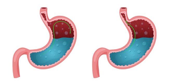 Halsbrann | refluks | Syreskade på tenner